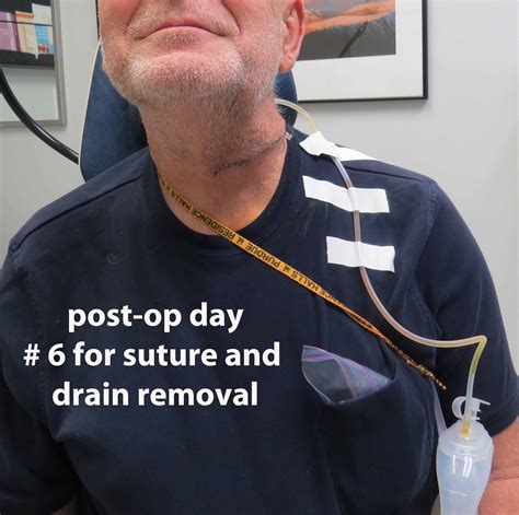 Case Example 2 Retrograde Sialendoscopy To Prevent Retained Ductal