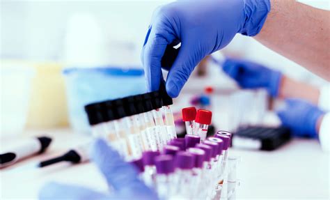 Urine Gene Test Can Predict Bladder Cancer Years Before Diagnosis