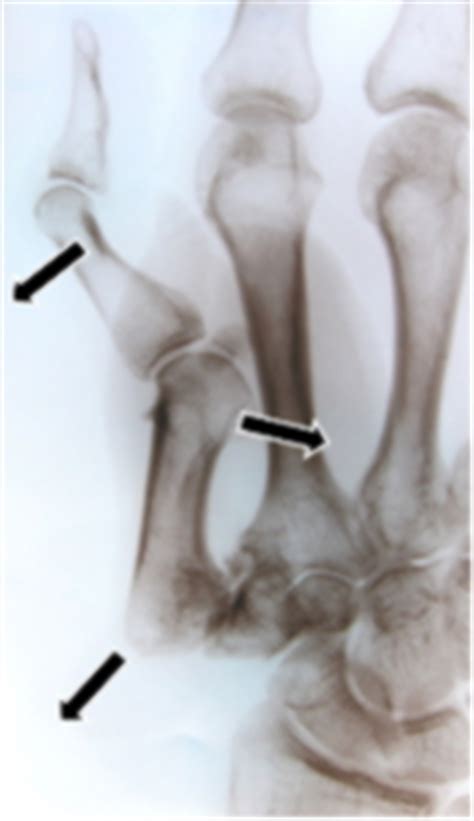 Osteoarthritis Thumb CMC Joint