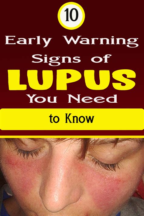 10 Early Warning Signs Of Lupus You Need To Know