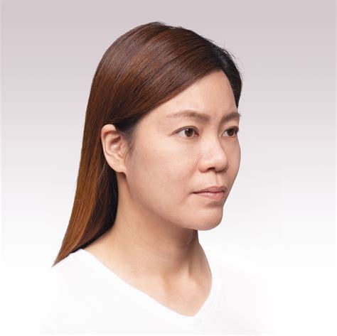 Harmonyca™美神針 雙效療程