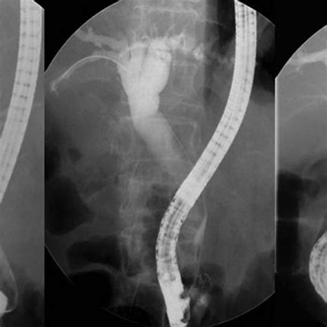 Ercp Findings For The Cbd Malignant Obstruction Group Group B Showing Download Scientific