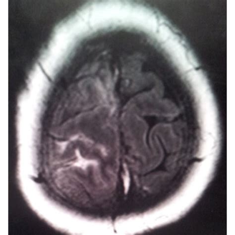 Brain Mri And Magnetic Resonance Mr Venography Ap View A