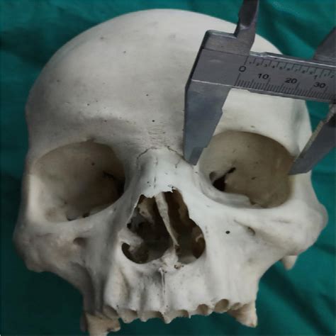Determination Of Sex From The Morphometry Of Orbits In Adult Skull Of