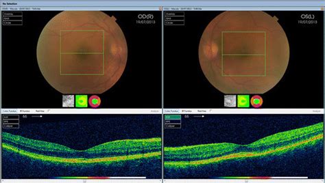 3d Oct Scan Showing Presence Of Normal Macula And No Evidence Of Fluid