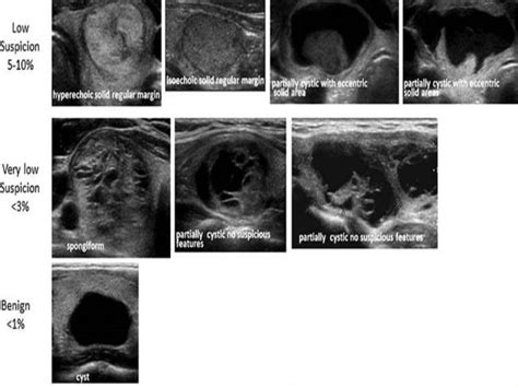 Thyroid Nodule Evaluation
