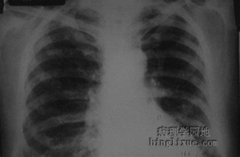 胸部X线片显示转移性成骨性骨肿瘤