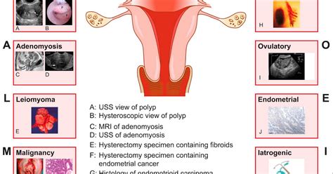 Abnormal Vaginal Uterine Bleeding Signs Symptoms Causes And Hot Sex