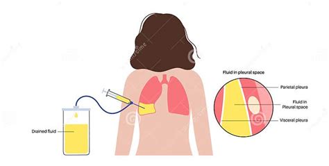 Thoracentesis Medical Procedure Stock Vector Illustration Of