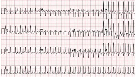 Hyperthyroid Archives Dr Smiths Ecg Blog