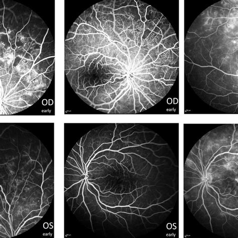 Fundus Fluorescein Angiography Showed Multiple Microaneurysms With Download Scientific Diagram