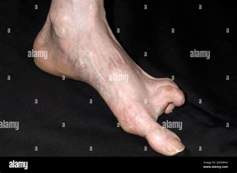 Model Released Scleroderma Deformed Foot Of A 62 Year Old Man With