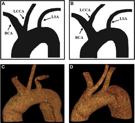 Prevalence And Clinical Implications Of Bovine Arch Variant In Type B