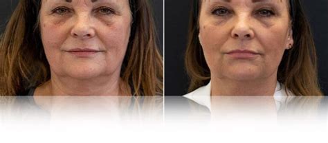 Endolift® Non Surgical Face Lifts Nova Aesthetic Clinic London