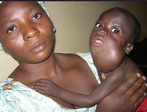 Cystic Hygroma Symptoms Causes Treatment My Health And Fitness