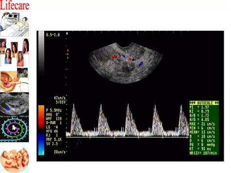 Practical Tips For Monitoring Of An Iui Cycle Ppt