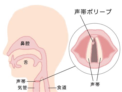 夫が声帯ポリープの手術をしました 困りもん暮らしメモ
