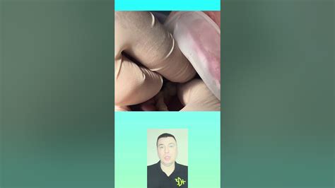 ОРТОПЕДИЧНА робота із 7 одиниць із діоксиду цирконію Zro2 стоматолог мем виниры