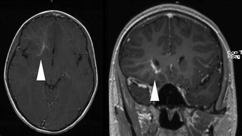Cavernous And Venous Malformations Neupsy Key