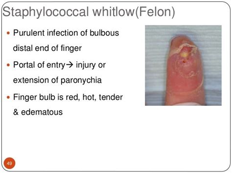 Streptococcal Skin Infections Pictures Pictures Photos