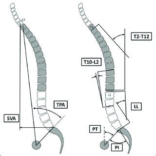 Classic Radiographic Sagittal Parameters PI PT LL PI LL TK TPA