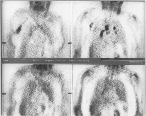 Hilar Mediastinal And Right Axillary Nodal Metastases From Breast