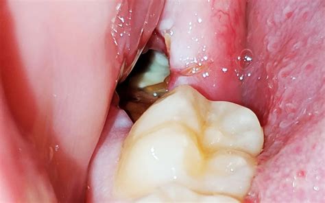 What Does A Wisdom Tooth Dry Socket Look Like