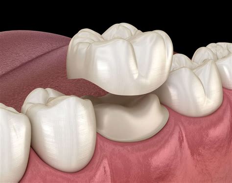 How Long Do Dental Crowns Last Kawveh Nofallah Dmd