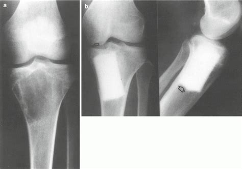 Bioceramics Musculoskeletal Key