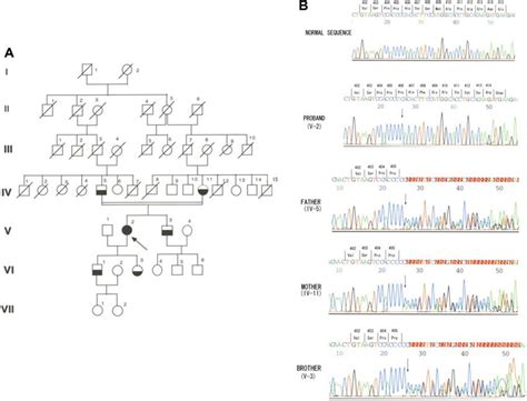 A Novel Frameshift Mutation In Exon 10 Of The Kininogen Gene Found In A