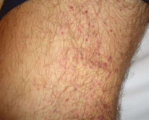 purpura thrombocytopenic idiopathic autoimmune thrombocytopenic
