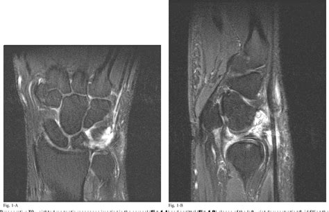 Figure 1 From Reconstruction Of Triangular Fibrocartilage Complex Avulsions Palmar 1c With