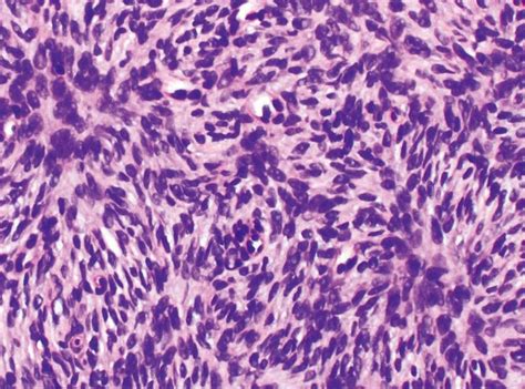 Dermatofibrosarcoma Protuberans Congénito Descripción De Un Caso