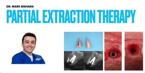 Partial Extraction Therapy Course Online Dental Library