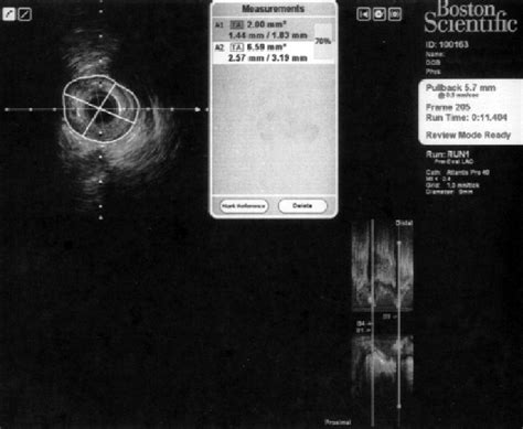 Coronary Stenosis In The Most Critical Region Assessed By Ivus Showing