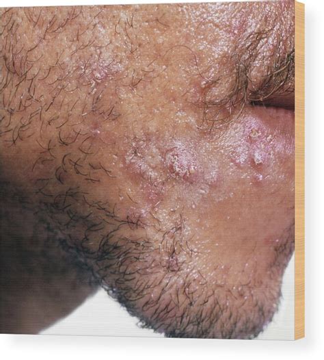 Acne Vulgaris Pustules On Mans Face Wood Print By Science Photo