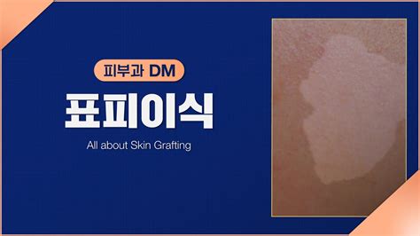 피부과 백반증 치료 ‘표피이식미세피부이식수술 과정과 장점 알아보기 Youtube