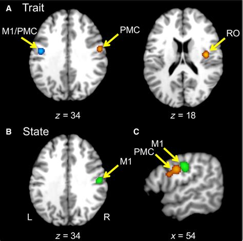 Stuttering As A Trait Or A State Revisited Motor System Involvement In