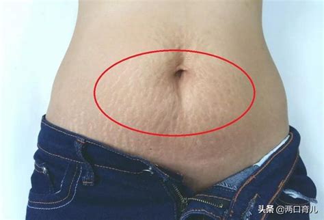 孕期是否會有妊娠紋，靠這3個因素決定，對比一下看看自己是不是 每日頭條