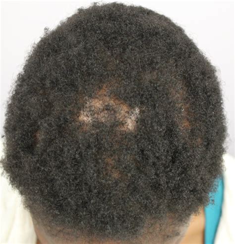 Central Centrifugal Cicatricial Alopecia Ccca Diagnosis And