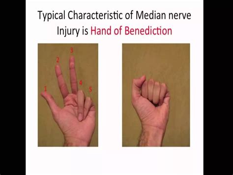 Radial Ulnar And Median Nerve Injuries Pptx