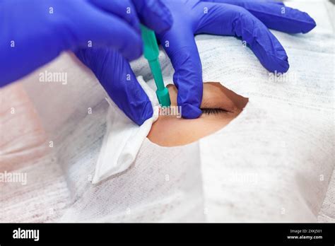 Skin Lesion Removal Procedure Dermatologist Carrying Out A Removal Of