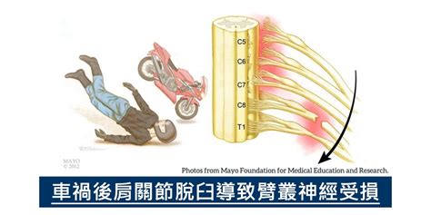 車禍後肩關節脫臼導致臂叢神經受損 手術修復後成果 手外科醫師醫療網