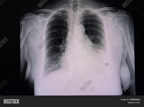 What Is Cephalization On Chest X Ray At Gail Carroll Blog