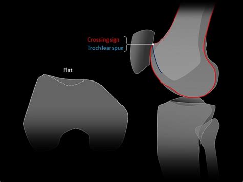 Trochlea Knee