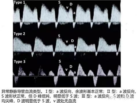 不可忽视的超声视角——胎儿静脉导管 知乎