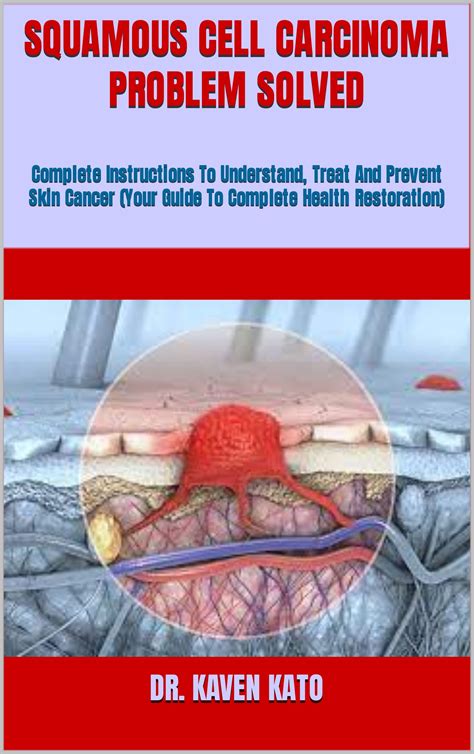 Squamous Cell Carcinoma Problem Solved Complete Instructions To
