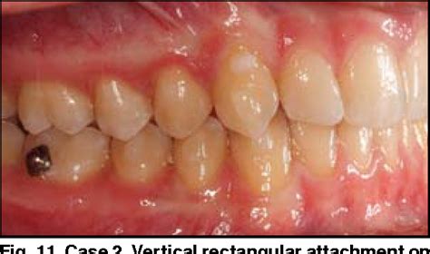 Class Ii Elastics Invisalign Whacking Webzine Bildergallerie