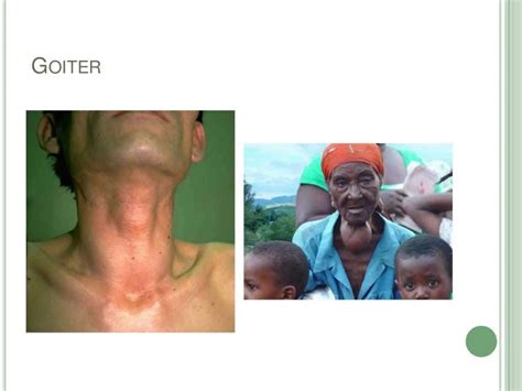 Thyroid Disorders Hyperthyroidism And Hypothyroidism Presentation Detailed Ppt