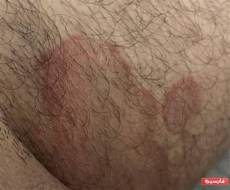قارچ پوستی کشاله ران تینیا کروریس چیست؟ درمان خارش